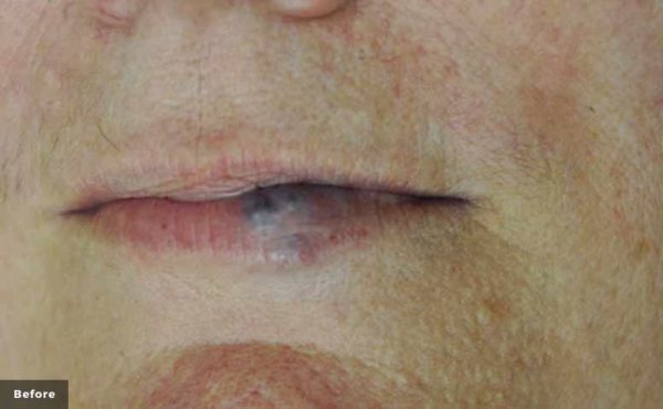 ANGIOMI CUTANEI - Studio Medico Dr. Giudice Enzo